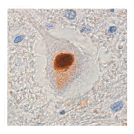 Blog: Modeling ALS: The Game's A FUS | ALS TDI